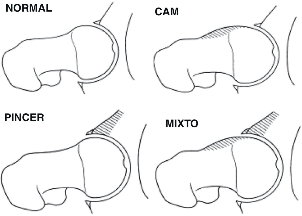 Fisioterapia En Pinzamiento Femoroacetabular | RehBody